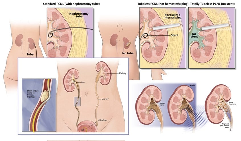 Tubeless Percutaneous Nephrolithotomy ~ DRHC Dubai Urology clinic